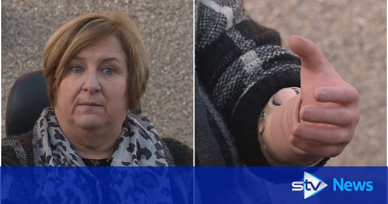 Woman who lost limbs after paper cut given first NHS bionic arm in ...