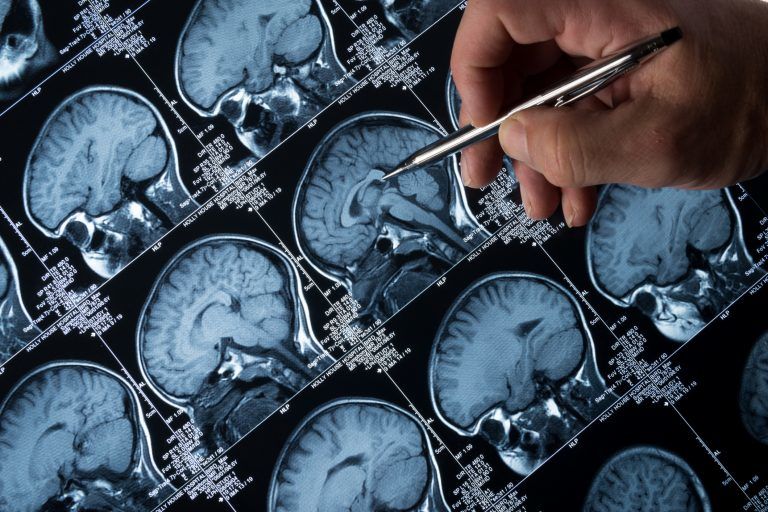 Scots student welcomes decision to approve new brain tumour treatment ...