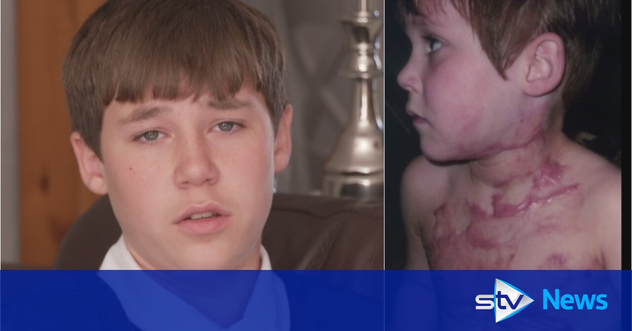 Teen scarred in freak firework accident still needs surgery ten years ...