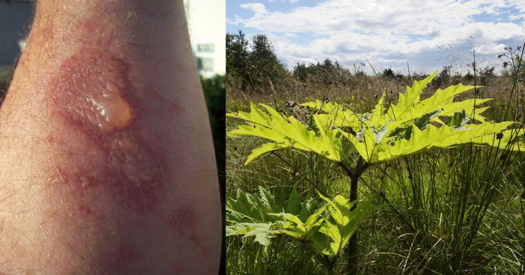 Scots warned of giant hogweed plant that can cause blisters, burns and ...