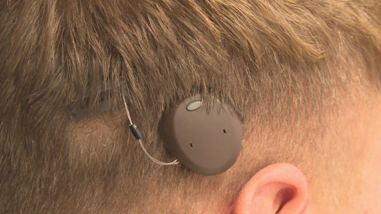 Dunblane teenager becomes first in Scotland to get revolutionary OSIA hearing implant | STV News