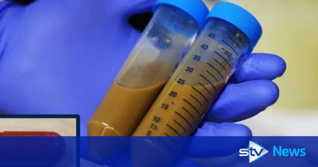 ‘Poo transplant’: Can consuming freeze-dried stool improve gut health ...