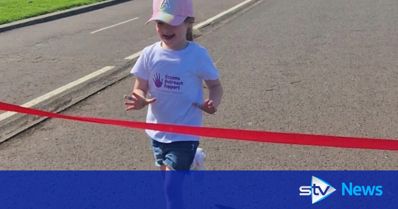 Girl with severe skin condition raises hundreds of pounds for charity ...