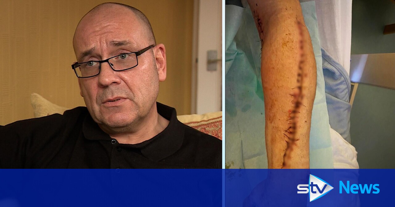 Helensburgh man 'trapped in own home' after NHS cancel reconstructive ...