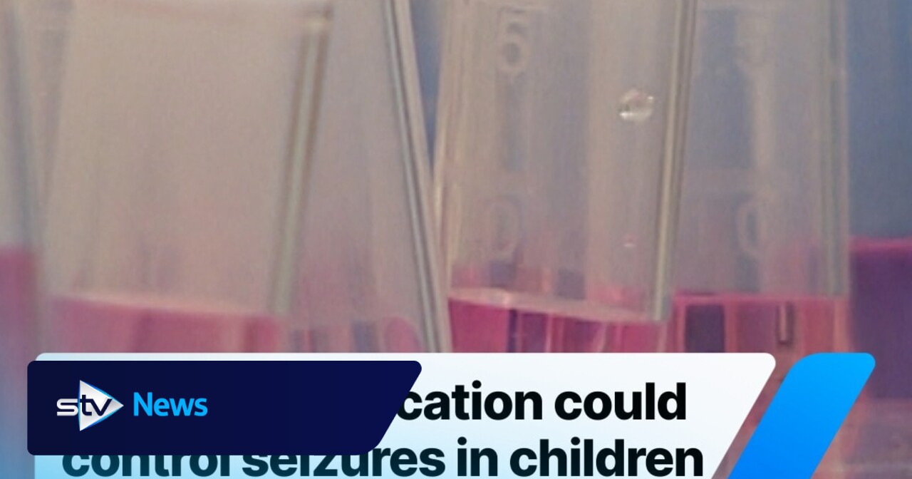 Epilepsy medication could control seizures in children with rare brain ...